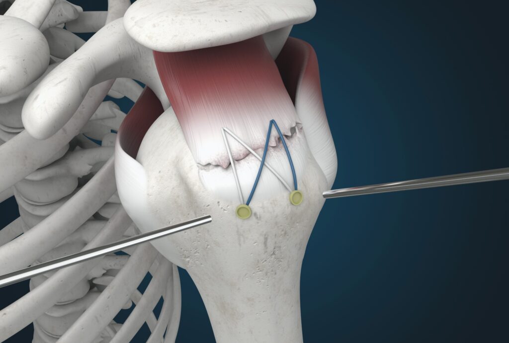 Réparation de la coiffe des rotateurs | Marseille | Dr Salabi