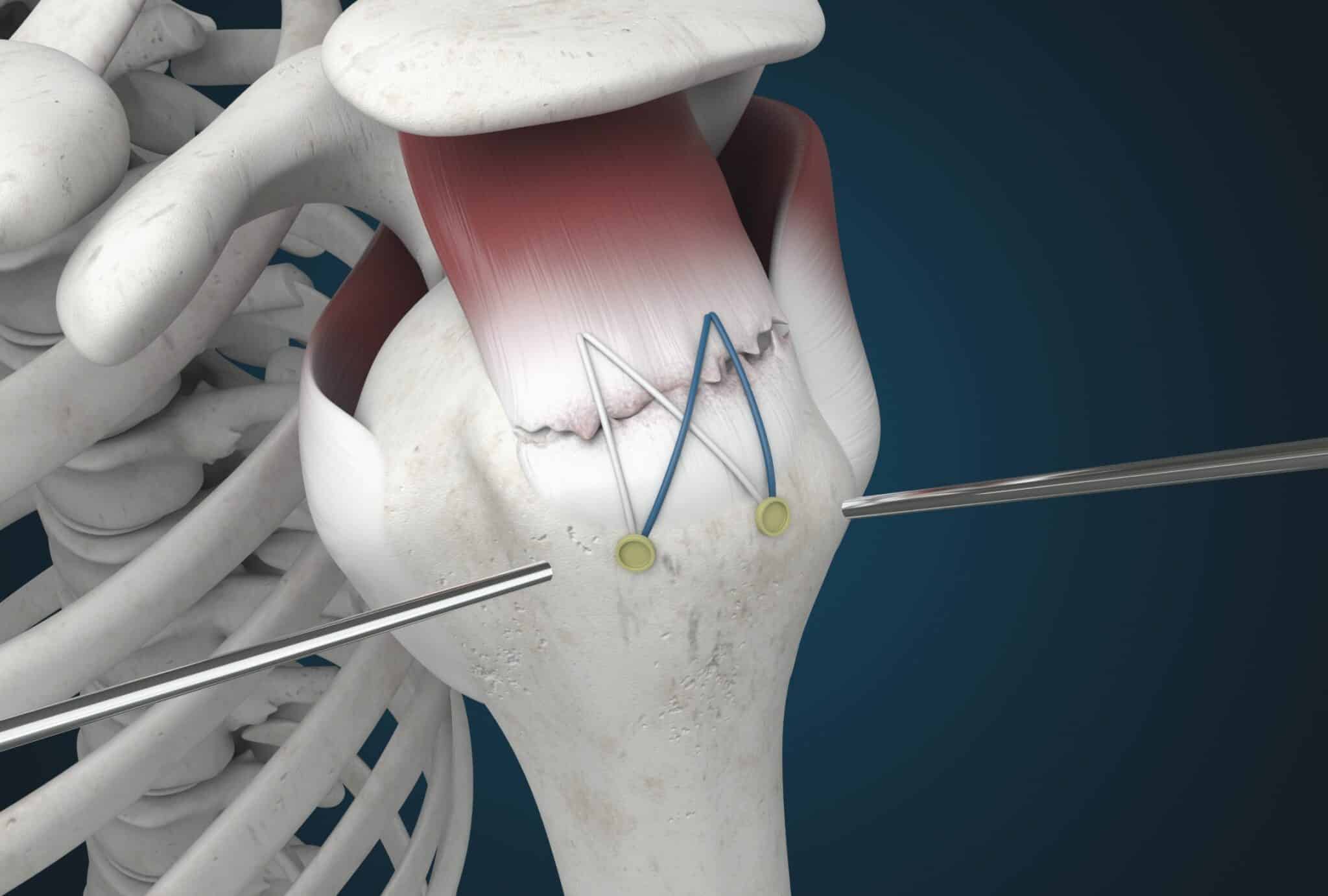 Réparation de la coiffe des rotateurs | Marseille | Dr Salabi
