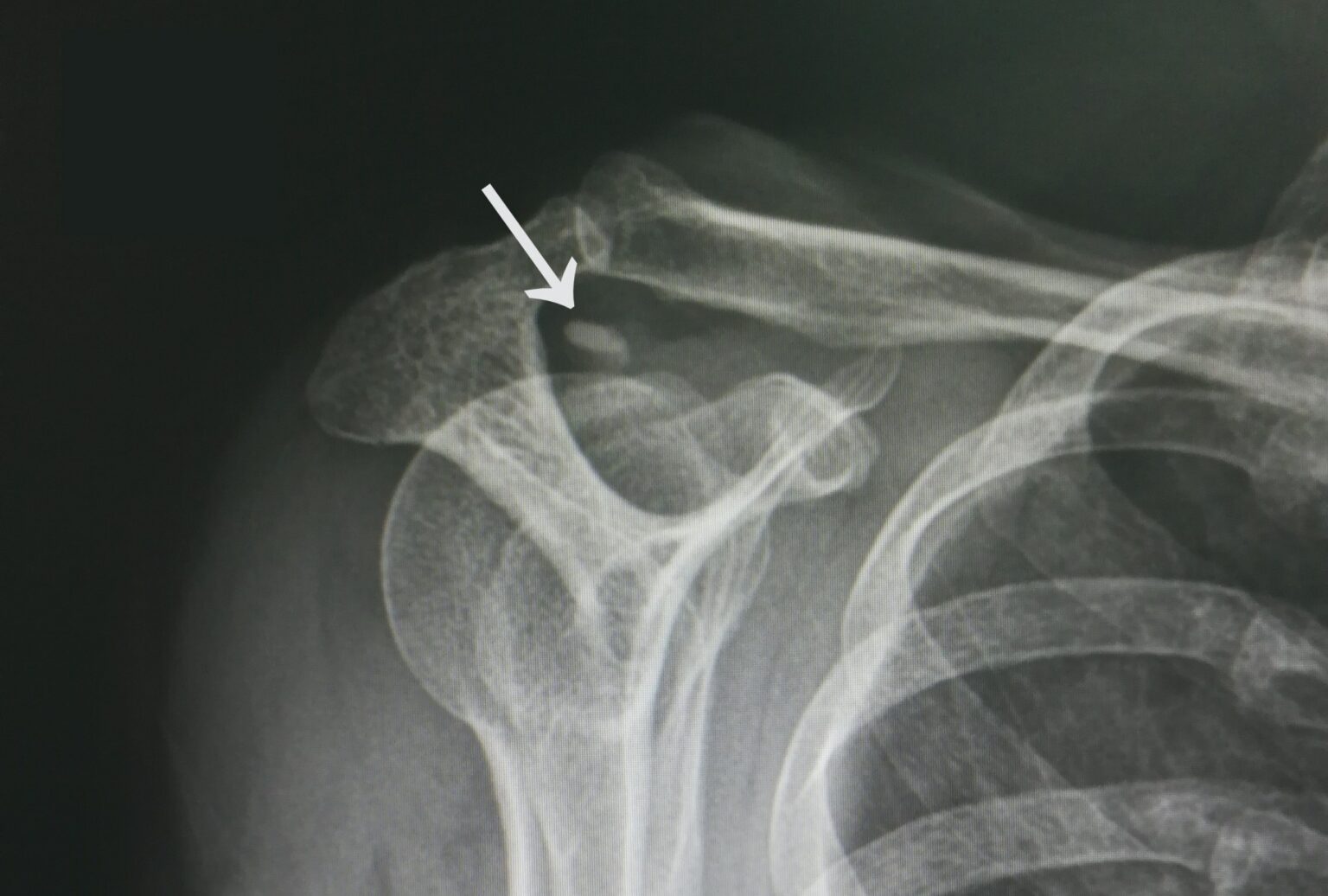 Calcification des tendons de l’épaule : tarif | Marseille | Dr Salabi