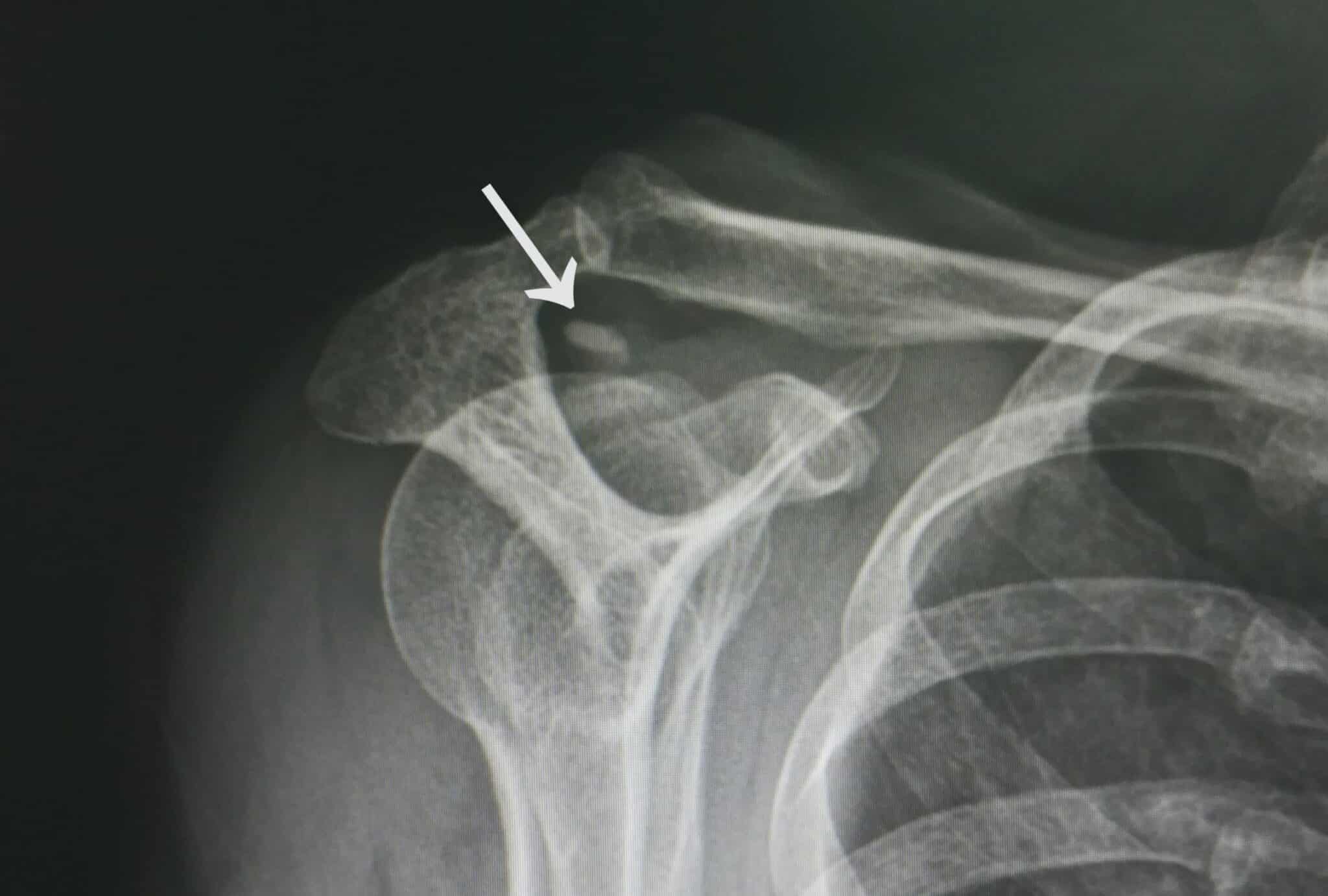 Calcification des tendons de l’épaule : tarif | Marseille | Dr Salabi