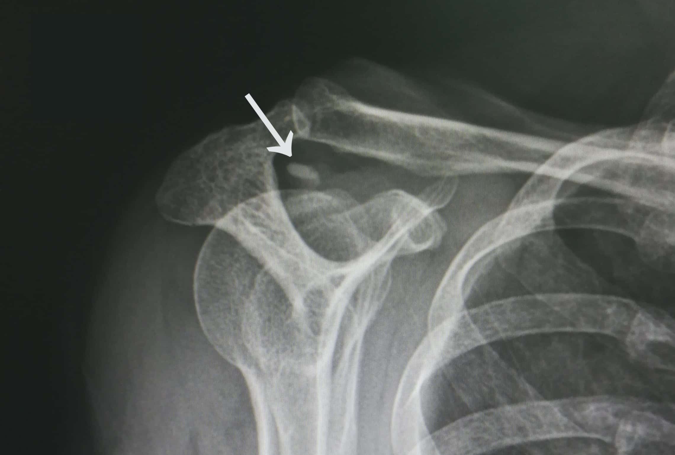 Calcification Des Tendons De L paule Tarif Marseille Dr Salabi