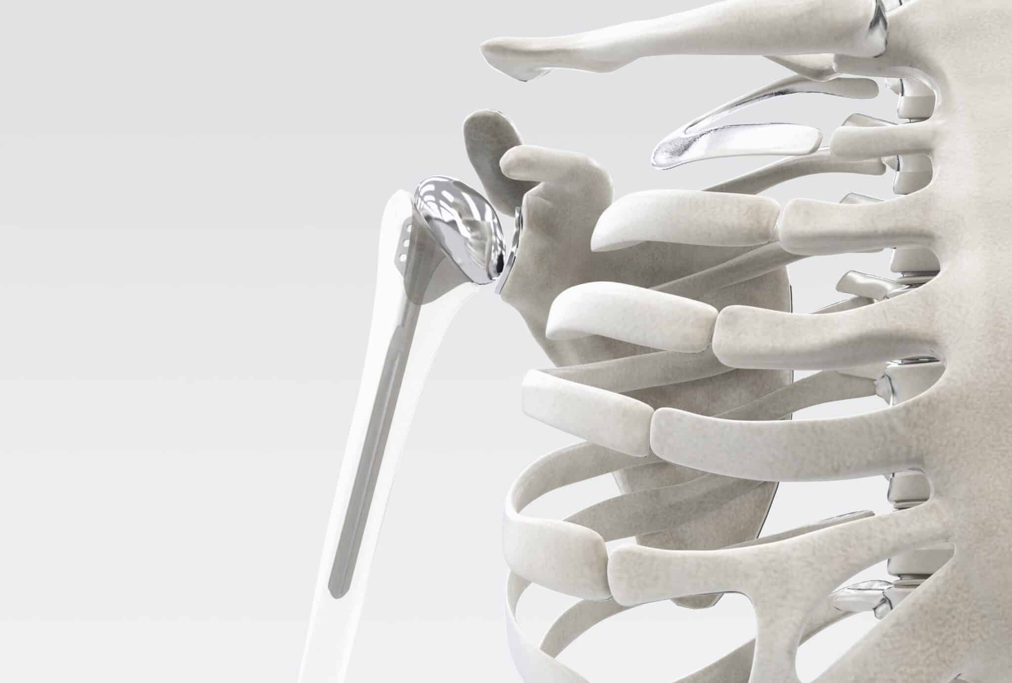 Prothèse totale de l'épaule : chirurgie | Marseille | Dr Salabi