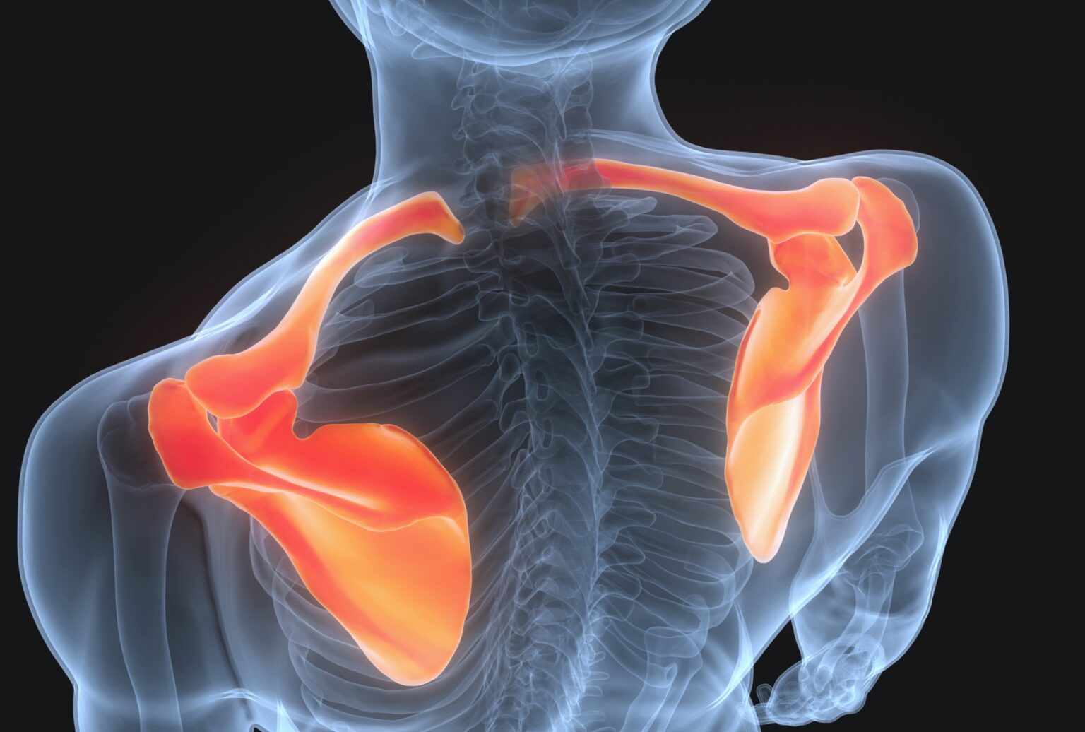 Résection acromio claviculaire : arthrose de l'épaule | Marseille | Dr ...