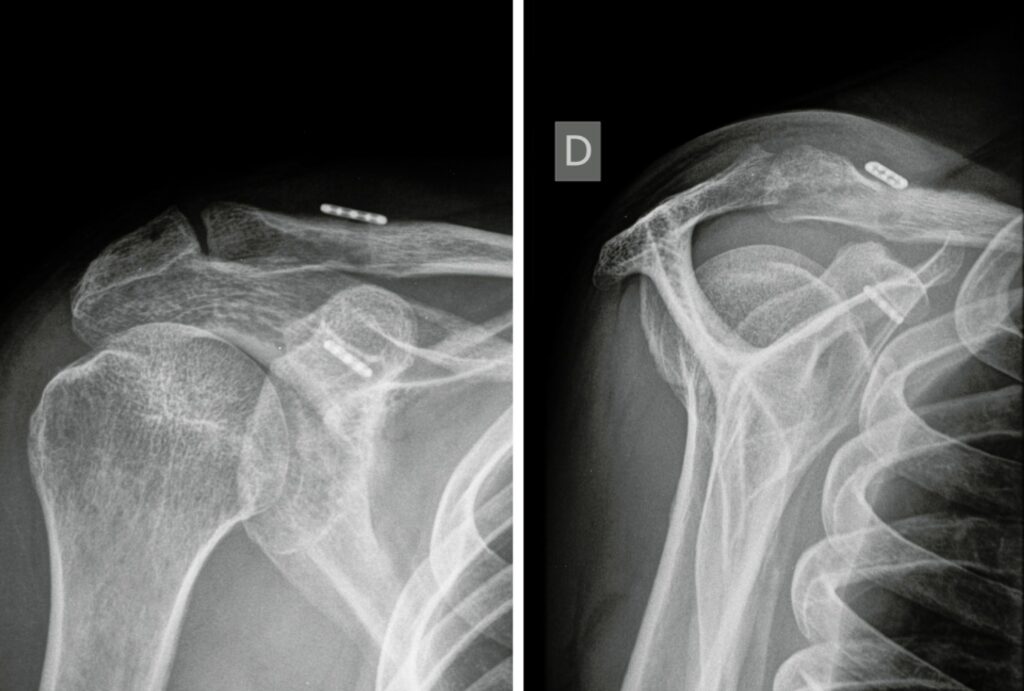 Stabilisation acromio-claviculaire : tarif | Marseille | Dr Salabi