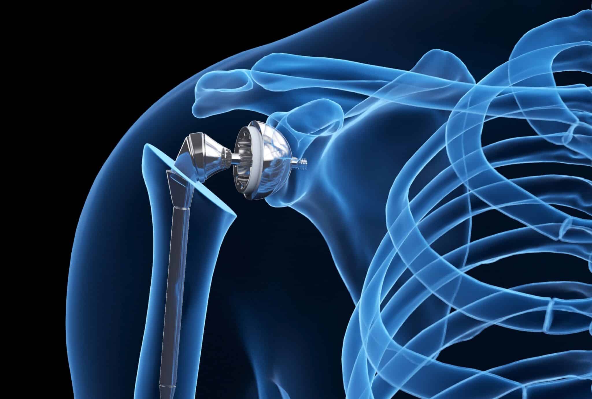 Prothèse anatomique d'épaule : chirurgie | Marseille | Dr Salabi