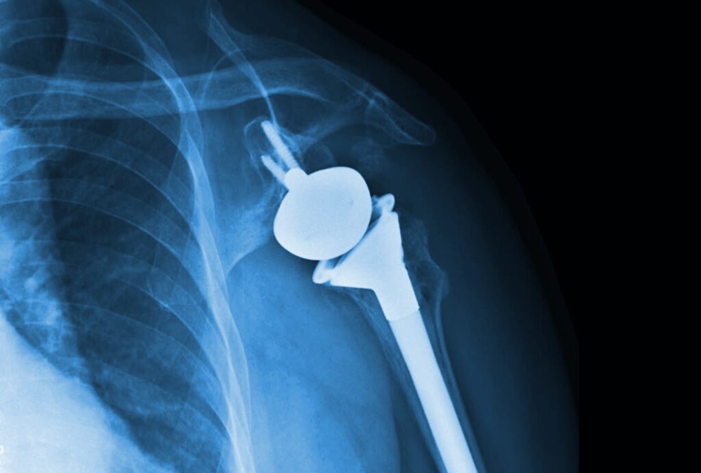 Prothèse inversée d'épaule : chirurgie | Marseille | Dr Salabi